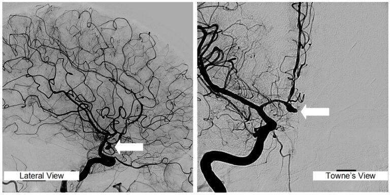 Aneurysm Coiling - Dr Tejas Dharia